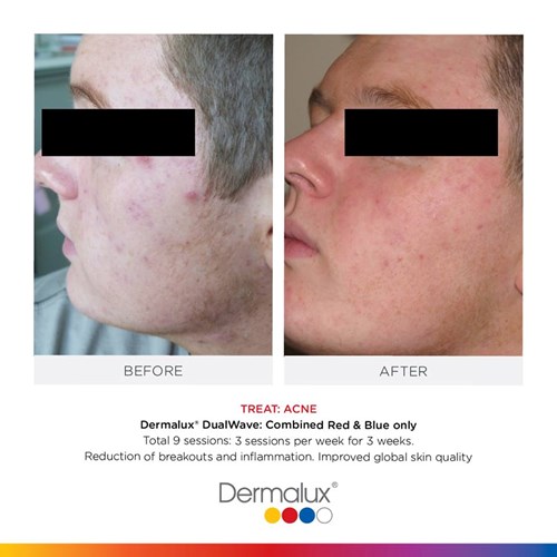 Dermalux™ LED | Jovilux