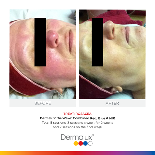 Dermalux™ LED | Jovilux