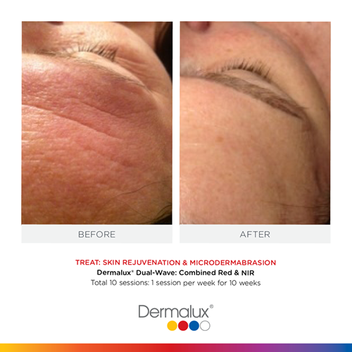 Dermalux™ LED | Jovilux